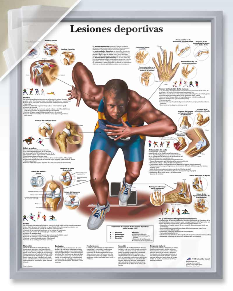 Sports Injuries (Spanish) Discount Anatomy Poster | ClinicalPosters