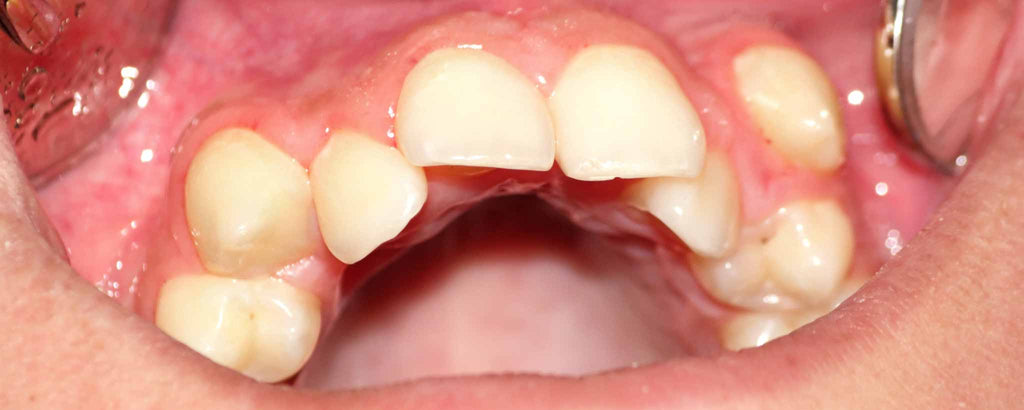 Reduce Teeth Overcrowding | ClinicalReads