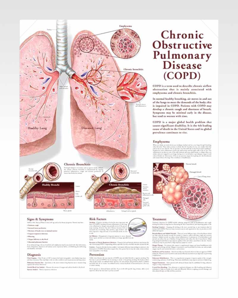 Laminated COPD Exam-Room Anatomy Poster | ClinicalPosters