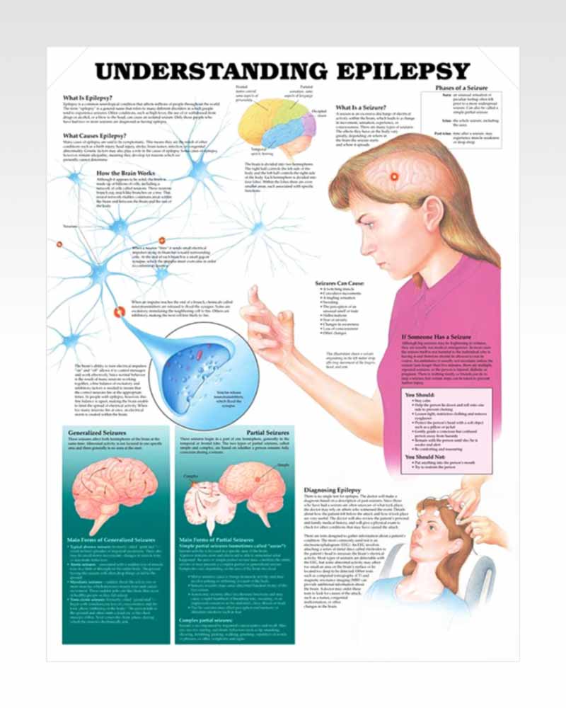 Laminated Epilepsy Human Anatomy Poster | ClinicalPosters