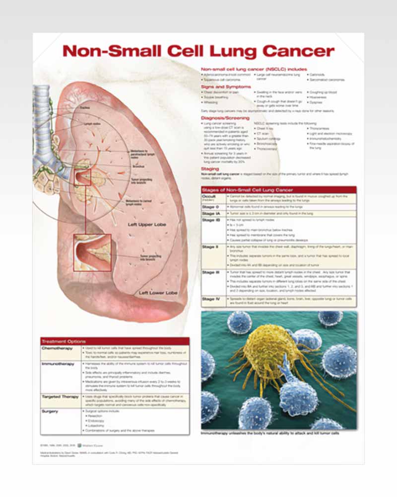Non-Small Cell Lung Cancer Laminated Anatomy Poster | ClinicalPosters