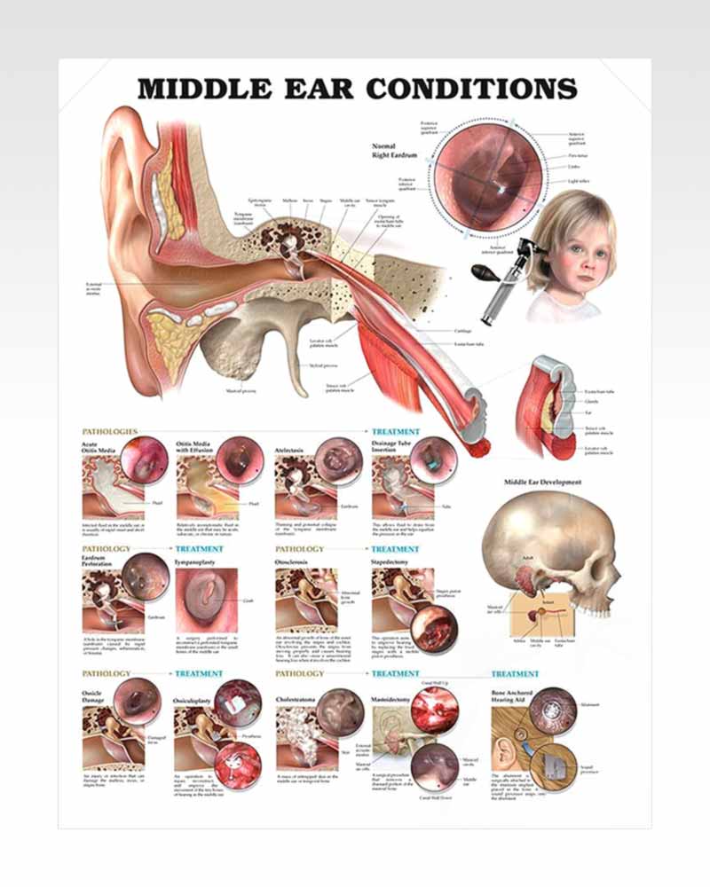 Laminated Middle Ear Conditions Anatomy Posters | ClinicalPosters
