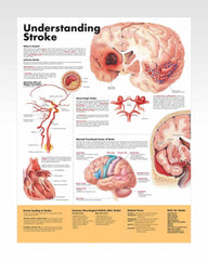 Laminated Understanding Stroke Anatomy Posters | ClinicalPosters