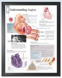 Understanding Angina Exam-Room Anatomy Poster | ClinicalPosters
