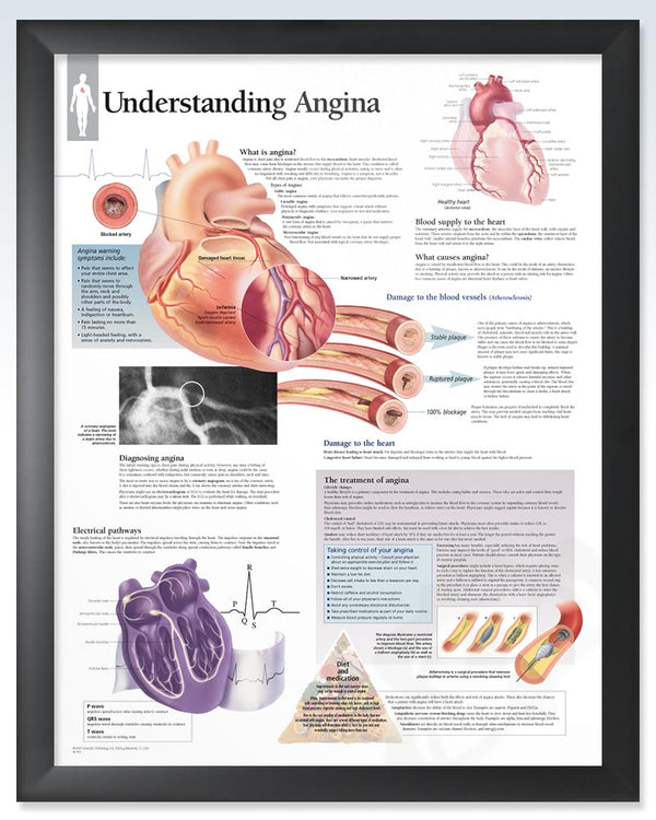 Understanding Angina Exam-Room Anatomy Poster | ClinicalPosters