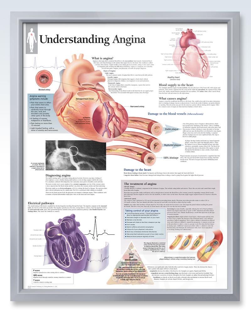 Understanding Angina Exam-Room Anatomy Poster | ClinicalPosters