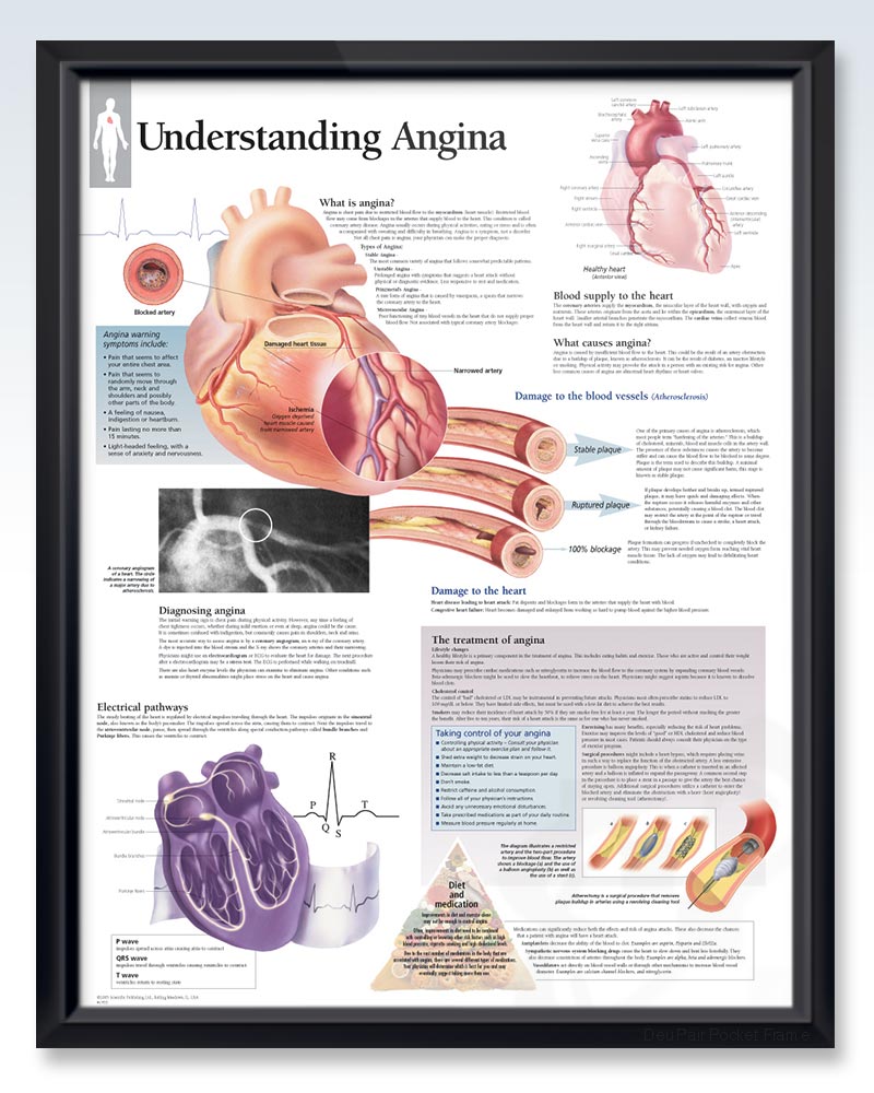 Understanding Angina Exam-Room Anatomy Poster – clinicalposters.com