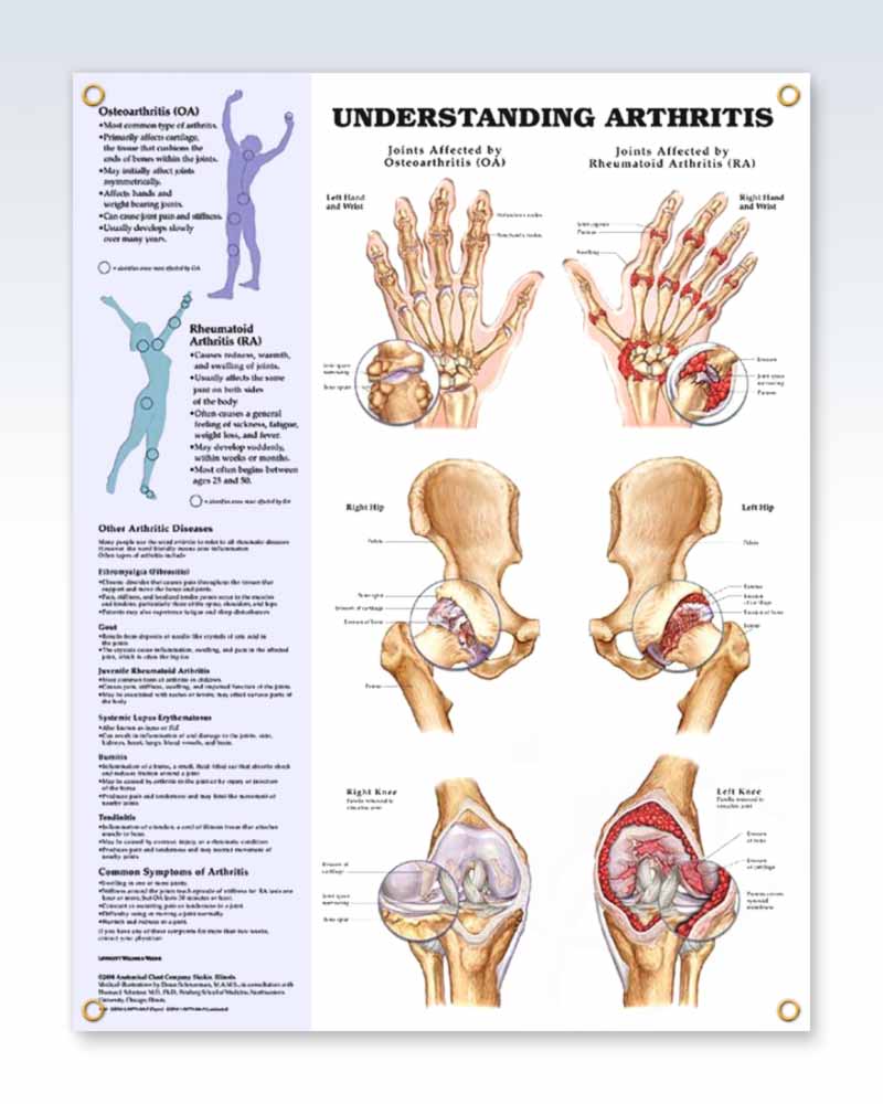 Laminated Arthritis Human Anatomy Poster | ClinicalPosters