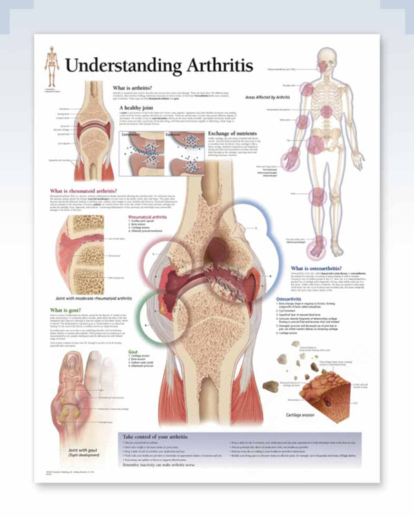 Understanding Arthritis Exam-Room Anatomy Poster | ClinicalPosters