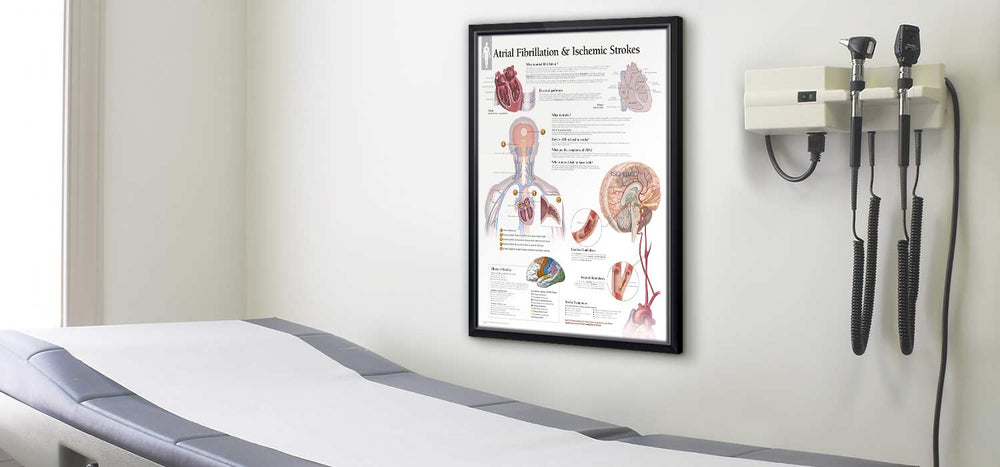 AFib and Ischemic Strokes Anatomy Posters | ClinicalPosters