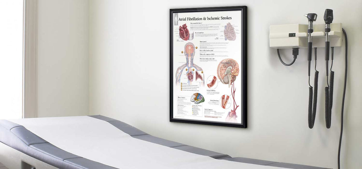 AFib and Ischemic Strokes Anatomy Posters | ClinicalPosters