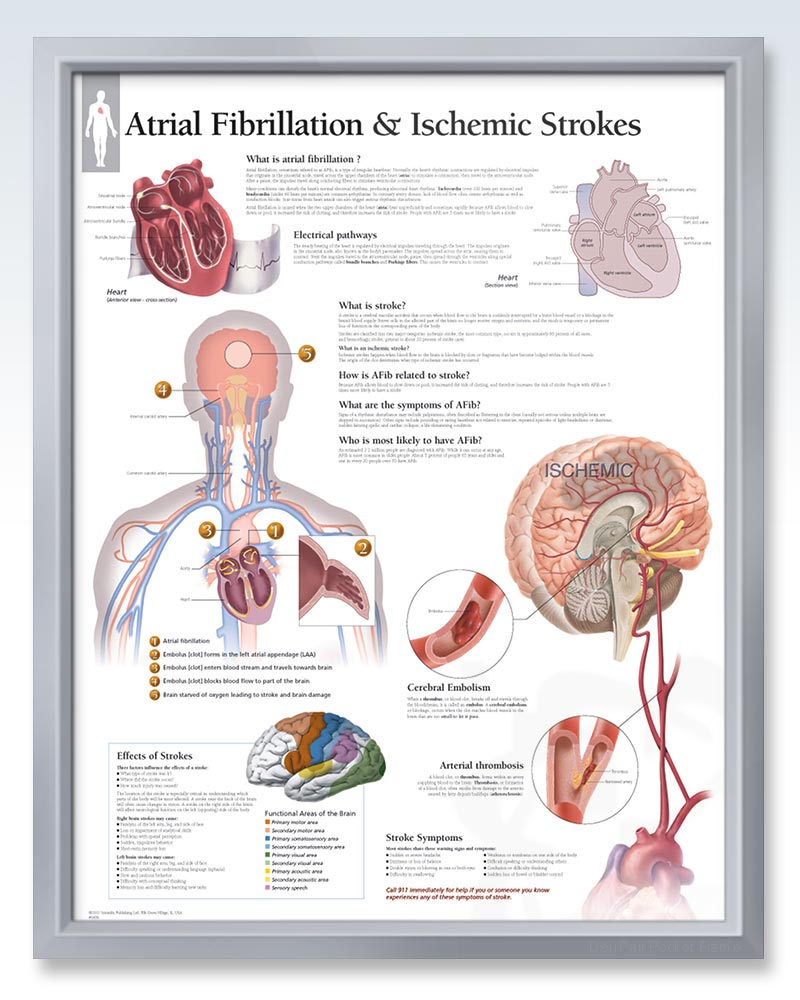 AFib and Ischemic Strokes Anatomy Posters | ClinicalPosters