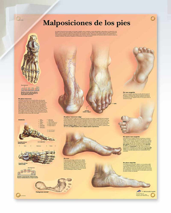 Discount Foot Deformities Chart (Spanish) | ClinicalPosters