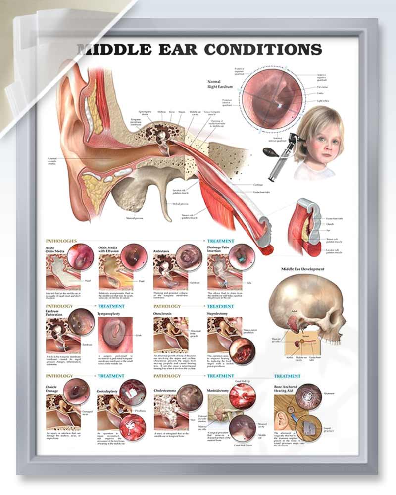 Middle Ear Conditions Discount Poster | ClinicalPosters