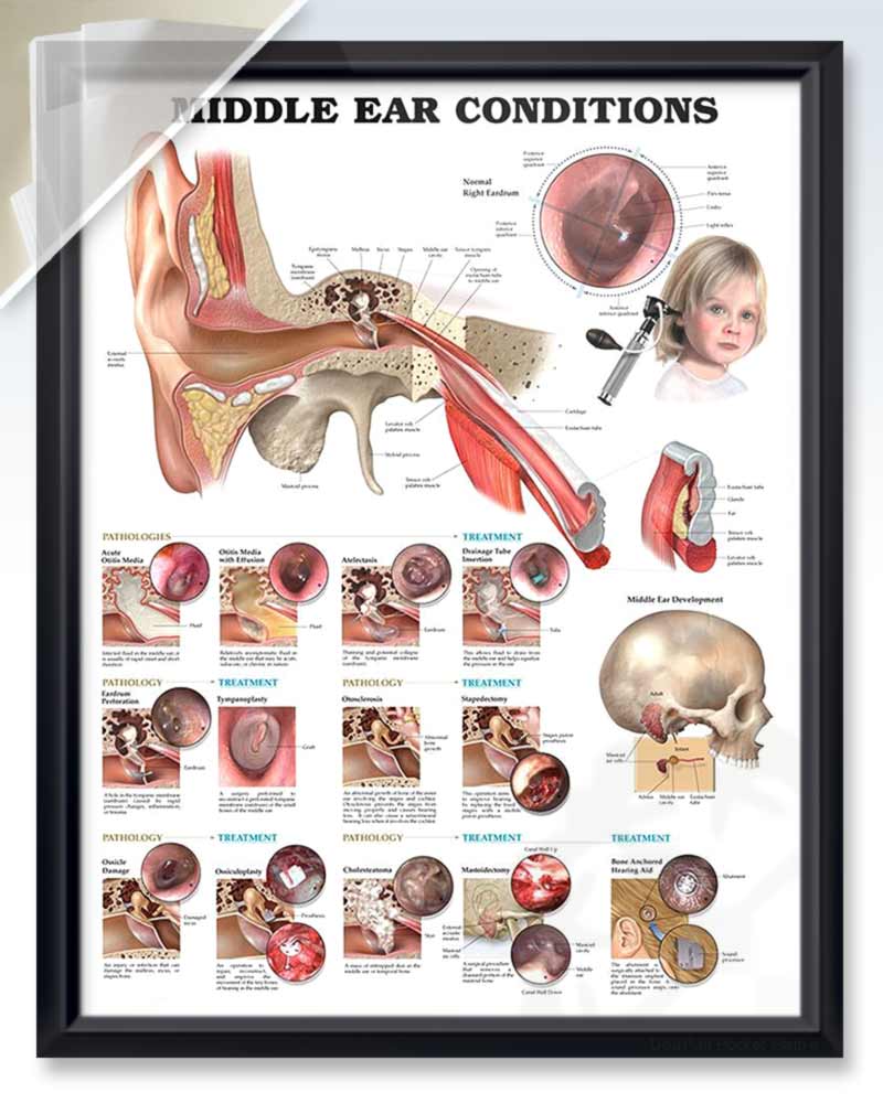 Middle Ear Conditions Discount Poster | ClinicalPosters