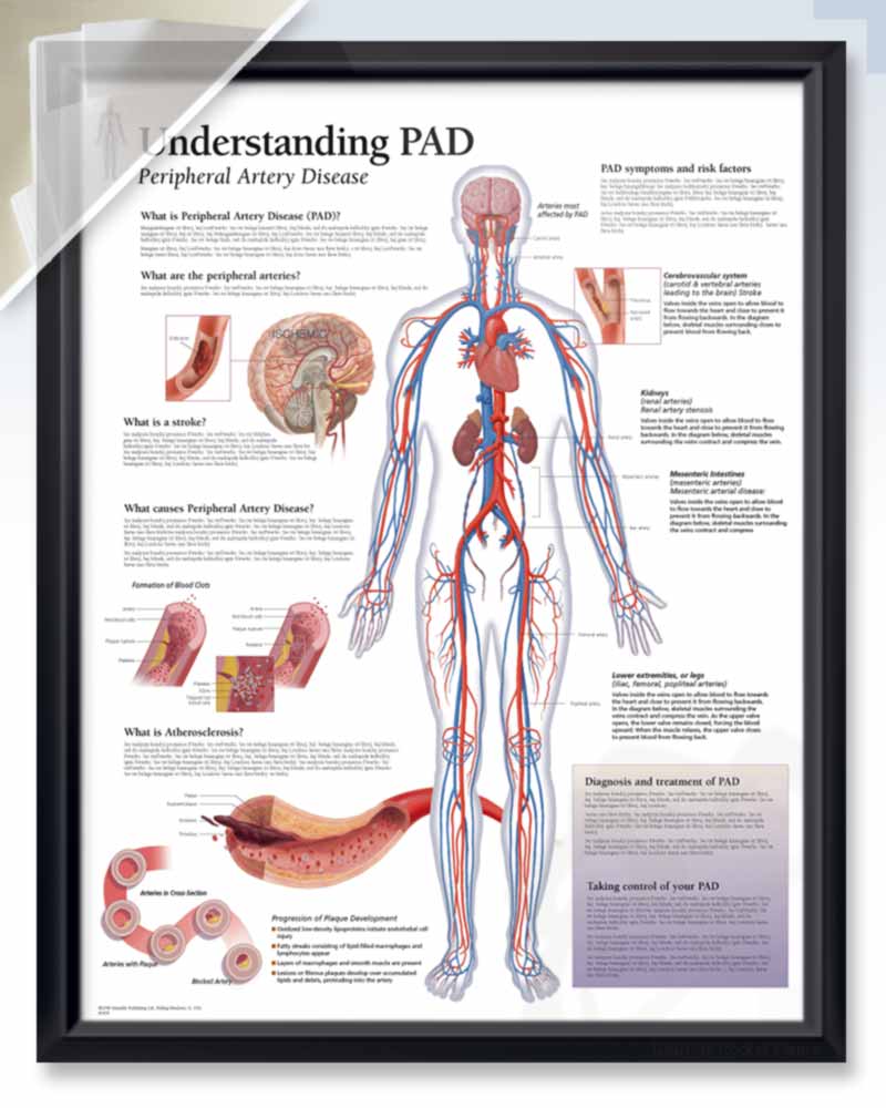 Understanding PAD Exam-Room Anatomy Poster – clinicalposters.com