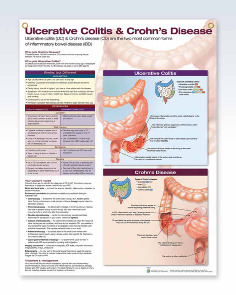 Ulcerative Colitis & Crohn's Anatomy Posters | ClinicalPosters