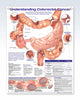 Laminated Colorectal Cancer Anatomy Poster | ClinicalPosters