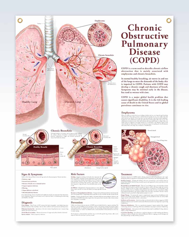 Laminated COPD Exam-Room Anatomy Poster | ClinicalPosters