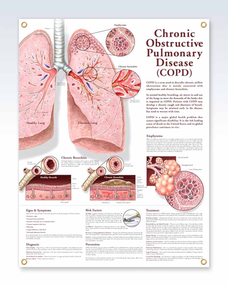 Laminated COPD Exam-Room Anatomy Poster | ClinicalPosters