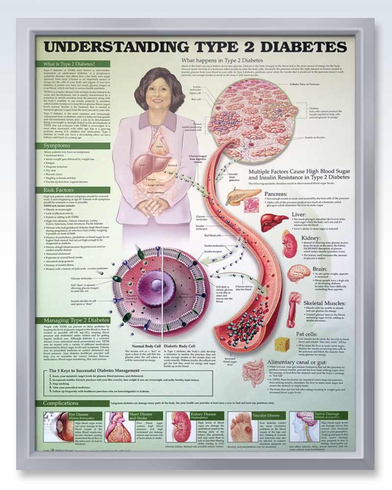 Type 2 Diabetes Exam-Room Human Anatomy Posters | ClinicalPosters