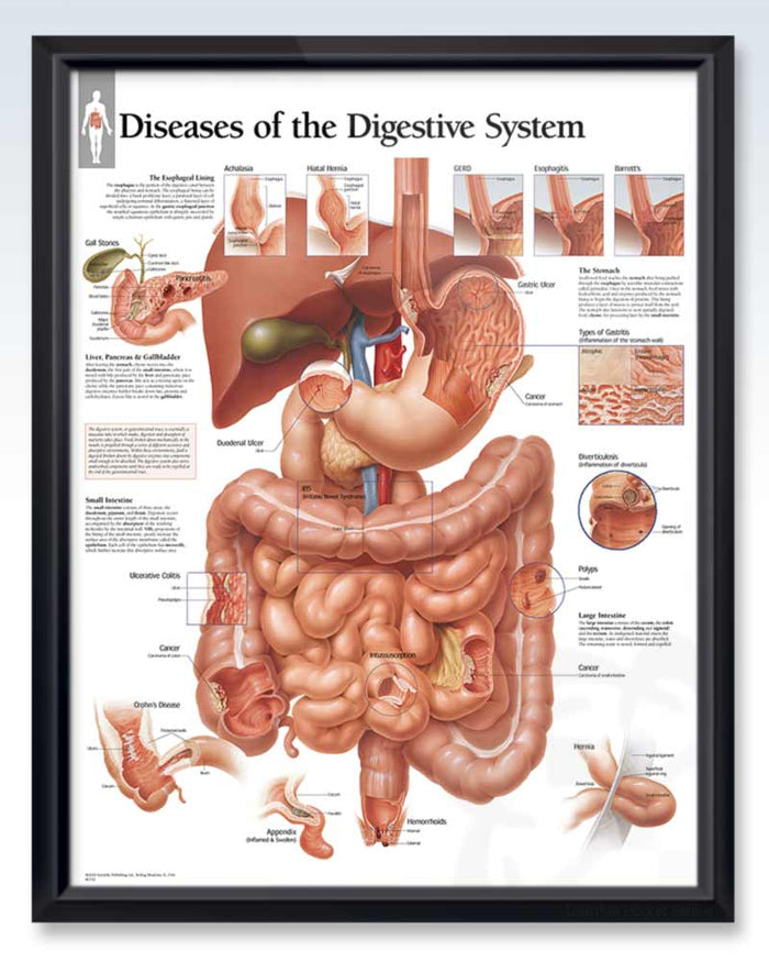 Digestive System Disease Anatomy Posters | ClinicalPosters