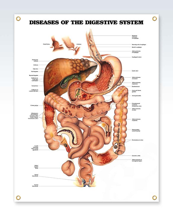 Laminated Digestive System Diseases Anatomy Posters | ClinicalPosters