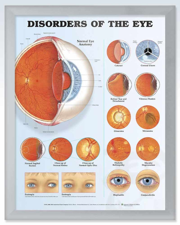 Disorders of the Eye Exam Room Anatomy Posters | ClinicalPosters