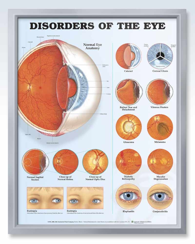 Disorders of the Eye Exam Room Anatomy Posters | ClinicalPosters