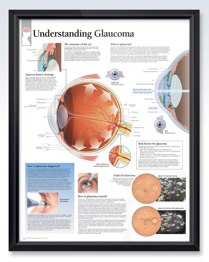 Understanding Glaucoma Exam-Room Anatomy Poster | ClinicalPosters