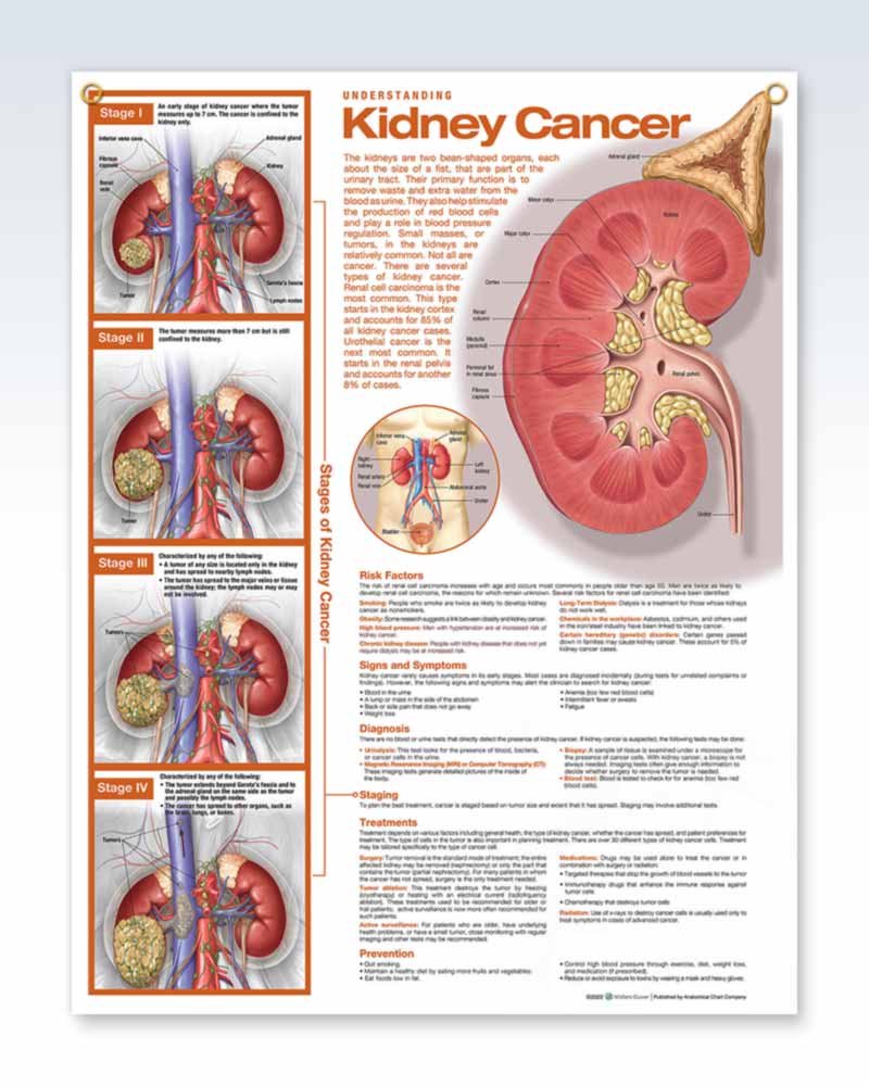 Kidney Cancer Exam-Room Anatomy Posters | ClinicalPosters