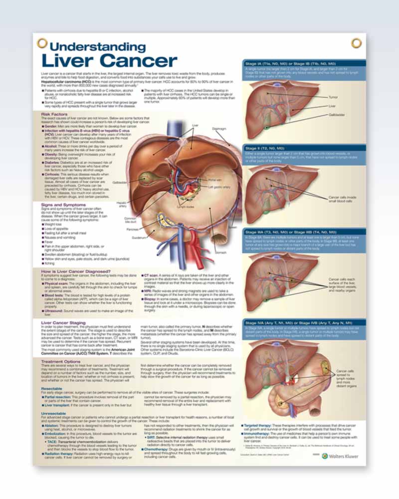 Liver Cancer 2E Exam-Room Laminated Posters | ClinicalPosters