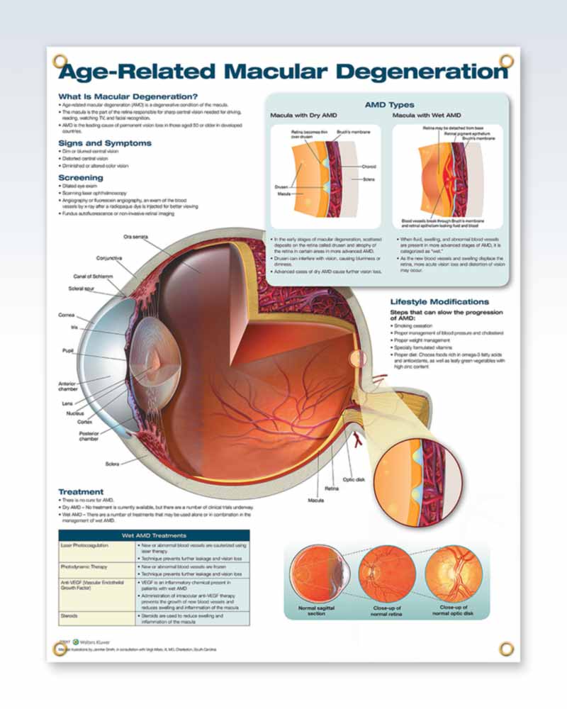 Age-Related Macular Degeneration Anatomy Poster | ClinicalPosters