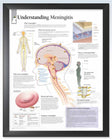 Meningitis Exam-Room Anatomy Poster | ClinicalPosters