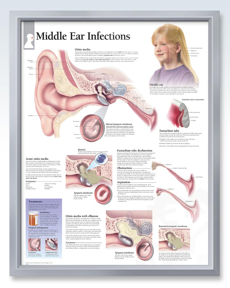 Middle Ear Infections Exam-Room Anatomy Poster | ClinicalPosters