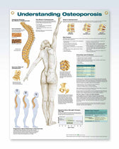 Osteoporosis Laminated Anatomy Poster | ClinicalPosters