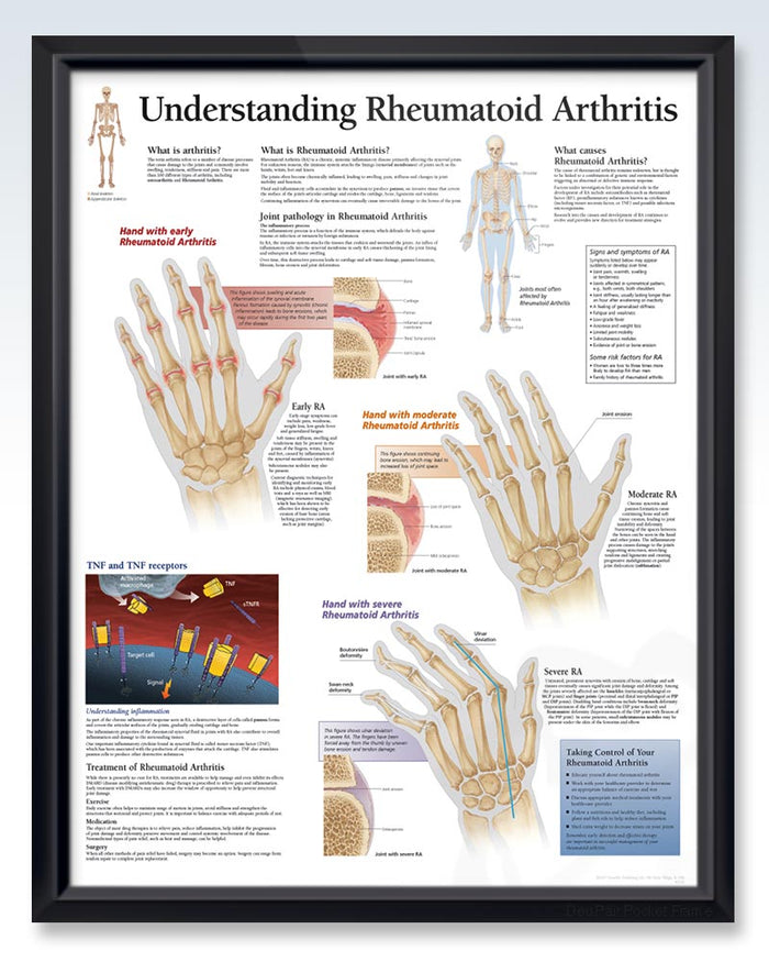 Rheumatoid Arthritis Exam-Room Human Anatomy Poster | ClinicalPosters