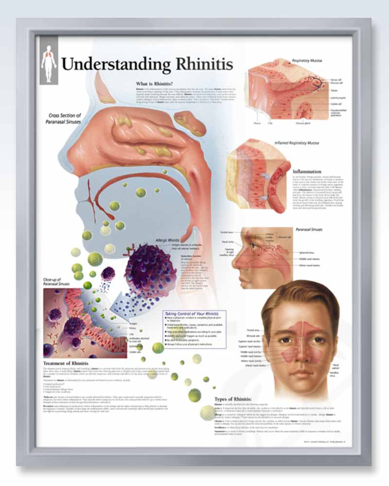 Understanding Rhinitis Exam-Room Anatomy Poster | ClinicalPosters