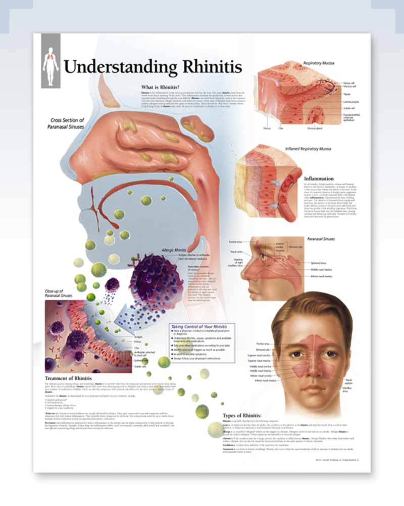 Understanding Rhinitis Exam-Room Anatomy Poster | ClinicalPosters