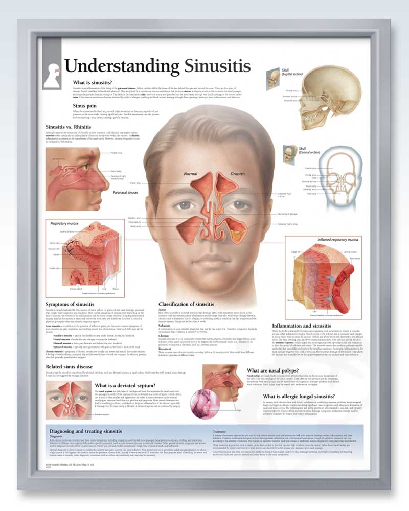 Understanding Sinusitis Exam-Room Human Anatomy Poster