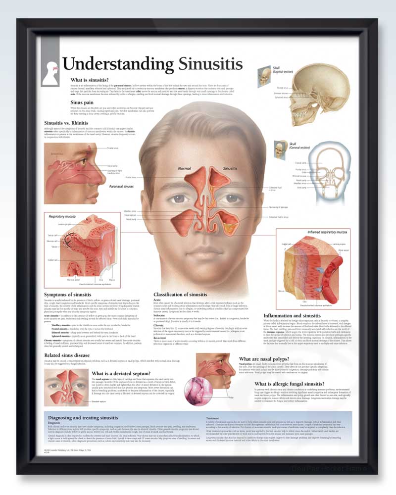 Understanding Sinusitis Exam-Room Human Anatomy Poster