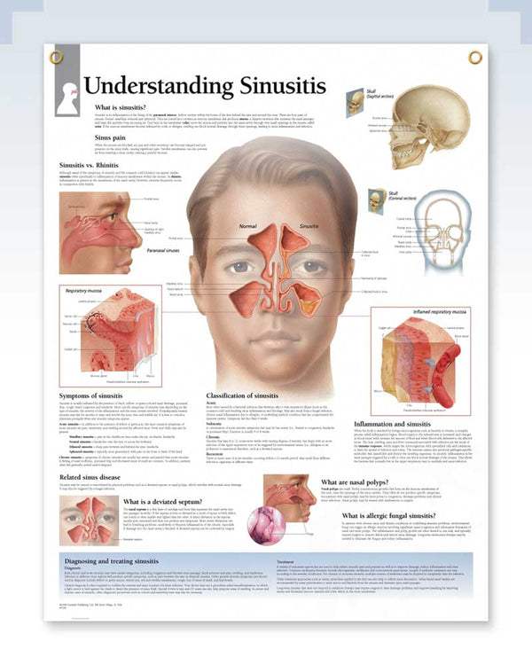 Understanding Sinusitis Exam-Room Human Anatomy Poster