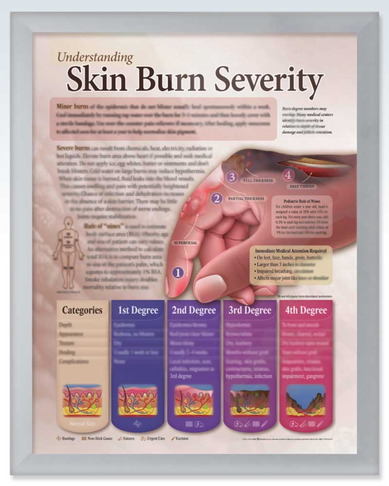 Skin Burn Severity Exam-Room Anatomy Posters – clinicalposters.com