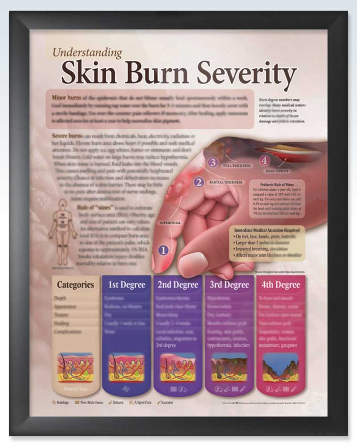 Skin Burn Severity Exam-Room Anatomy Posters | ClinicalPosters