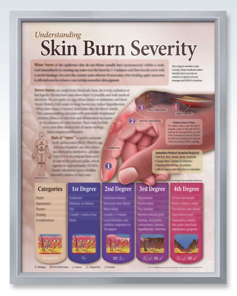 Skin Burn Severity Exam-Room Anatomy Posters | ClinicalPosters