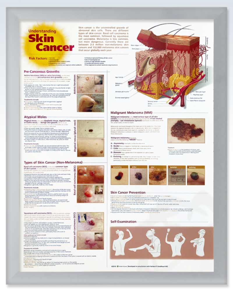 Skin Cancer Exam-Room Anatomy Posters – clinicalposters.com