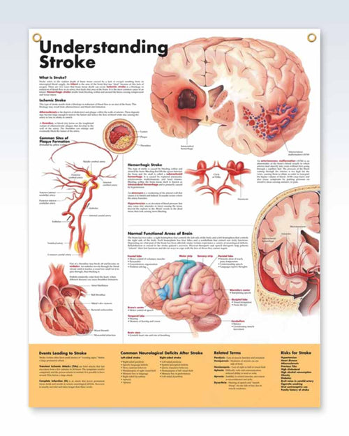 Laminated Understanding Stroke Anatomy Posters | ClinicalPosters