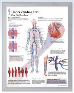 Understanding DVT Exam-Room Anatomy Poster | ClinicalPosters