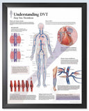 Understanding DVT Exam-Room Anatomy Poster | ClinicalPosters