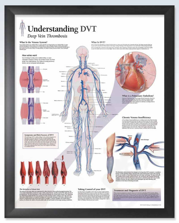 Understanding DVT Exam-Room Anatomy Poster | ClinicalPosters